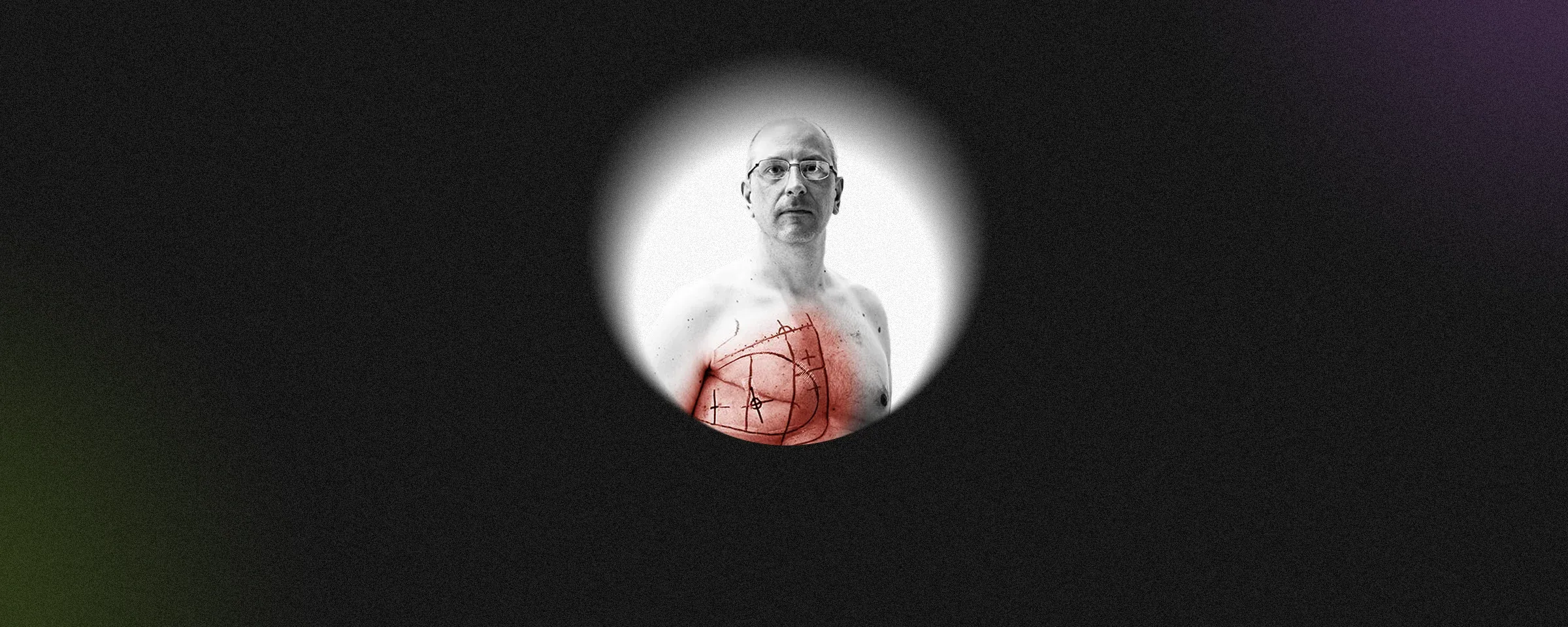 The Detailed Guide To Male Breast Cancer